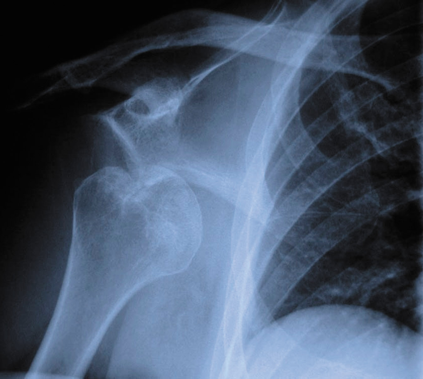 The Unstable Shoulder – South Florida Health and Wellness Magazine
