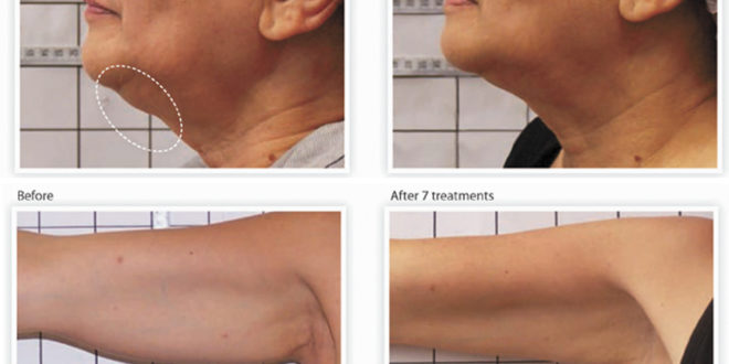 Is Loose and Sagging Skin Plaguing You? – South Florida Health and ...