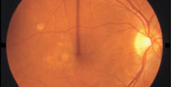 What Is Histoplasmosis? – South Florida Health and Wellness Magazine