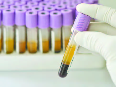 Hair Loss? Your Own Blood May Hold the Key to Regrowth! – South Florida ...