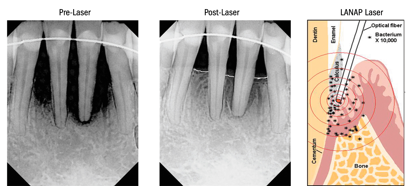 LANAP: A Painless Way to Treat Gum and Bone Loss – South Florida Health ...
