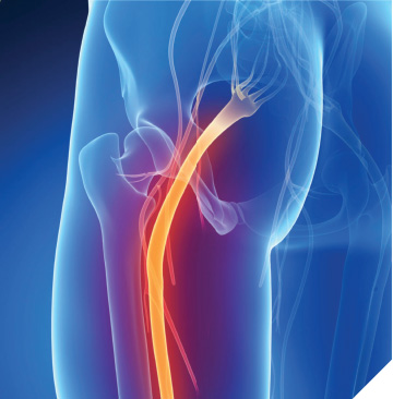 Pain Management for Sciatica SCIATICA TREATMENT – South Florida Health ...