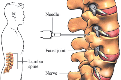 FACET JOINT INJECTIONS FOR BACK PAIN – South Florida Health and ...